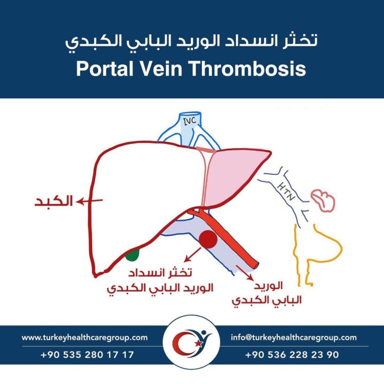 Hepatic portal vein thrombosis - Turkey Health Care Group